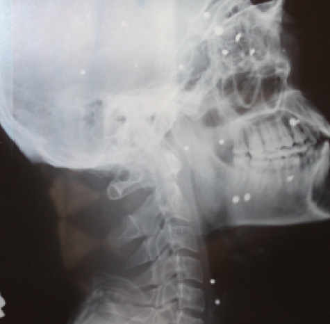 Devastating Situations: Severe Ocular Gunshot Injuries - Retina Today