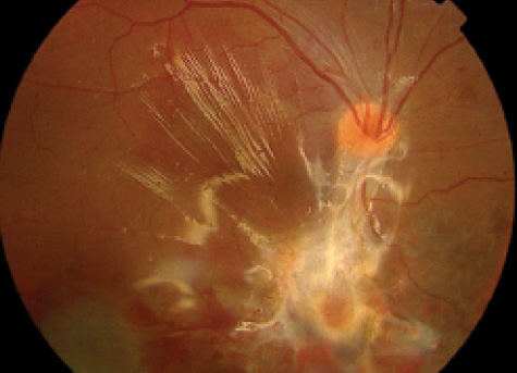 Devastating Situations: Severe Ocular Gunshot Injuries - Retina Today