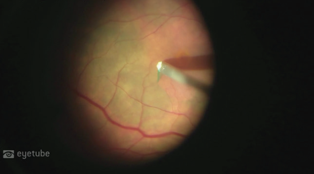 Eyetube Retina Channel Update - Retina Today