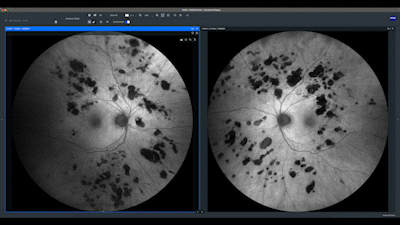 ZEISS Retina Workflow Solutions for Diabetic Patients - Retina Today