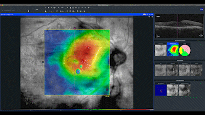 ZEISS Retina Workflow Solutions for Diabetic Patients - Retina Today