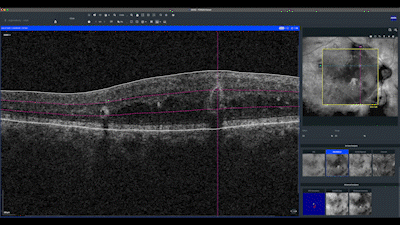 ZEISS Retina Workflow Solutions for Diabetic Patients - Retina Today