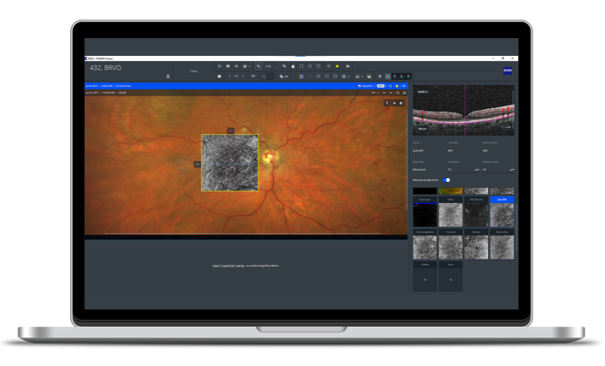 Zeiss Retina Workflow - Retina Today